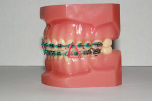 ELASTICS - Orthodontic Specialists
